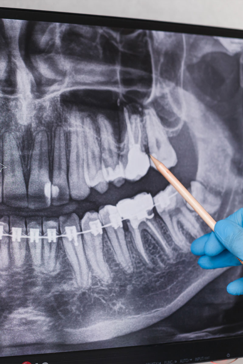 Why Do We Get Wisdom Teeth? Little Did You Know... - SYDNEY WISDOM ...